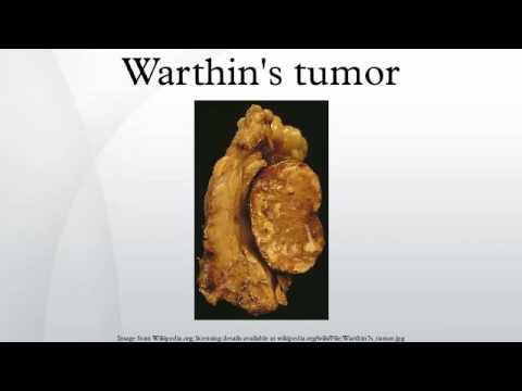 Warthin's tumor - YouTube
