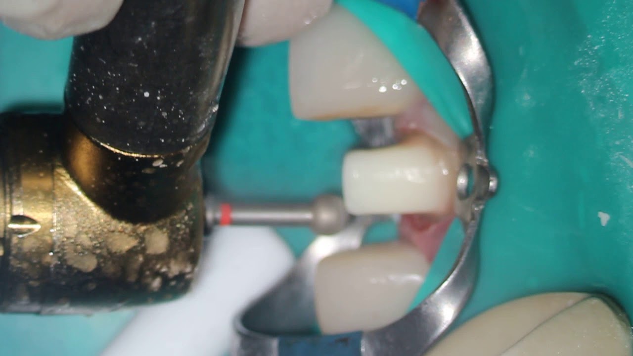 Tooth restoration - Fiber Glass Post/video 4 - YouTube