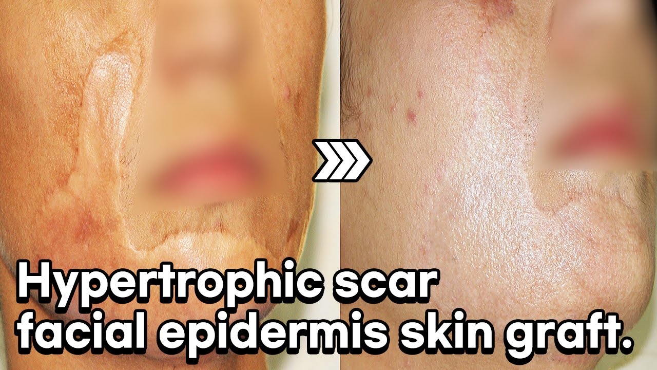 he underwent an epidermal skin graft. However, an unwanted hypertrophic ...