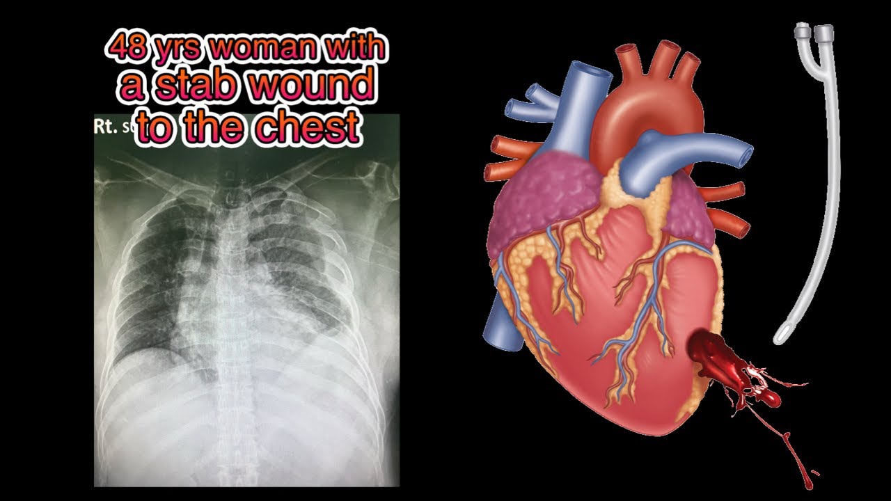 🫀A cardiac injury and pericardial tamponade following a stab wound to ...