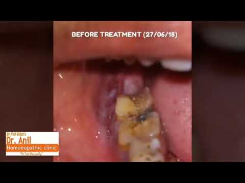 Leukoplakia /white spots in mouth/precancerous lesion in mouth - YouTube