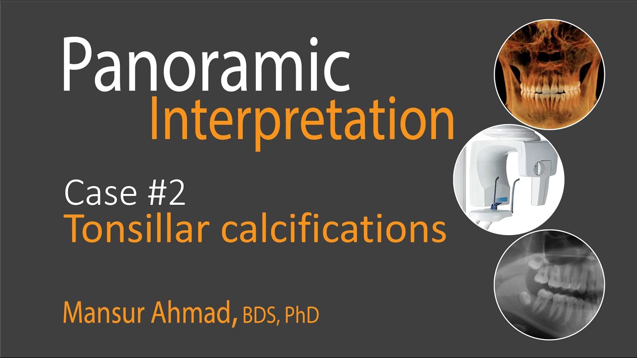 Tonsillar calcifications: Panoramic Radiographic Interpretations - YouTube