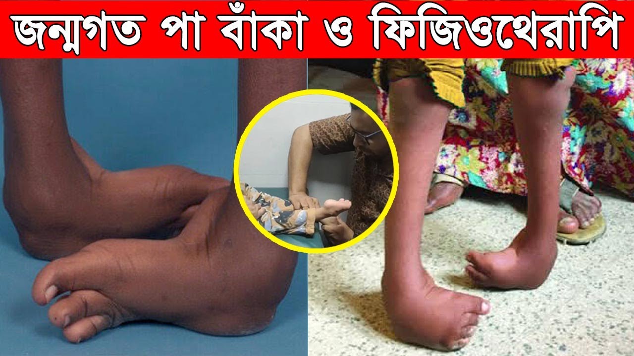 Exercises for children with club foot - YouTube