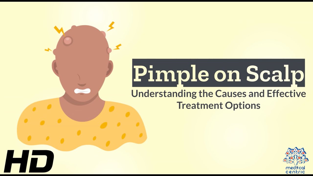 Scalp Pimples Unveiled: Causes and How to Deal with Them - YouTube