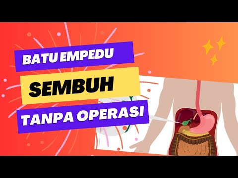 Sembuhkan penyakit batu empedu tanpa operasi
