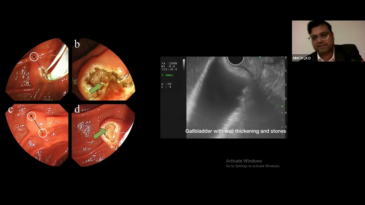 THERAPEUTIC ERCP IN CHILDREN, Dr Zaheer Nabi, Interventional Endoscopy ...