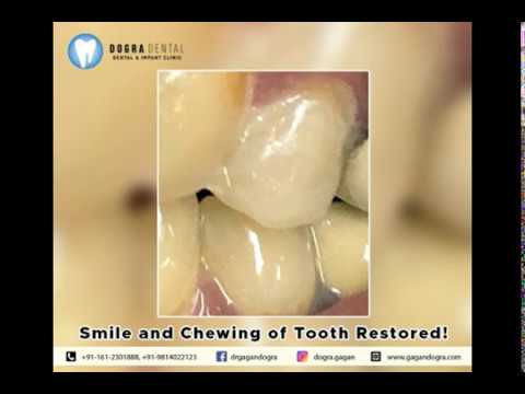 Broken Down Upper First Premolar Fix with Ceramic Onlay Fabricated ...