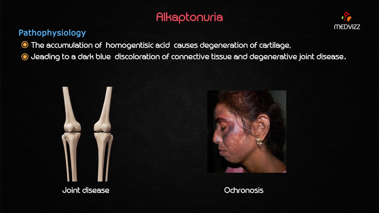 Ochronosis (or Alkaptonuria) - Usmle step 1 lecture - YouTube