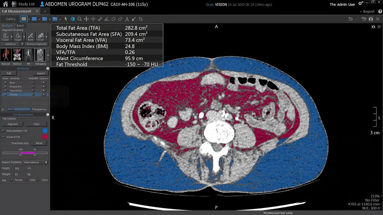 Vitrea Applications Overview | CT Fat Measurement - YouTube