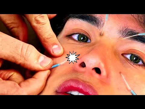 Trying Acupuncture - YouTube