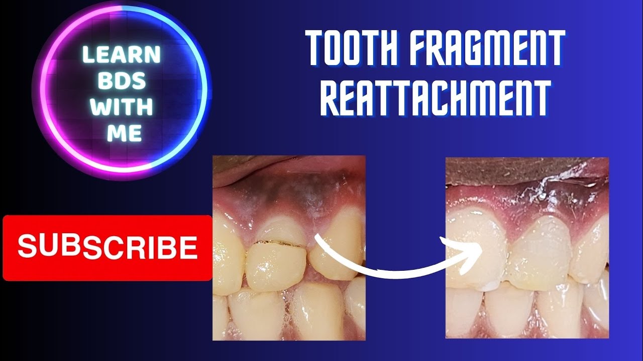 Tooth Fragment Reattachment - YouTube