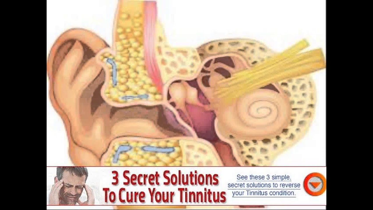 what does severe tinnitus sound like - YouTube
