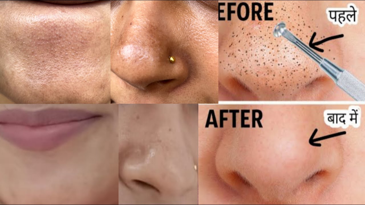 How to remove blackheads, whiteheads and tiny bumps from face - YouTube