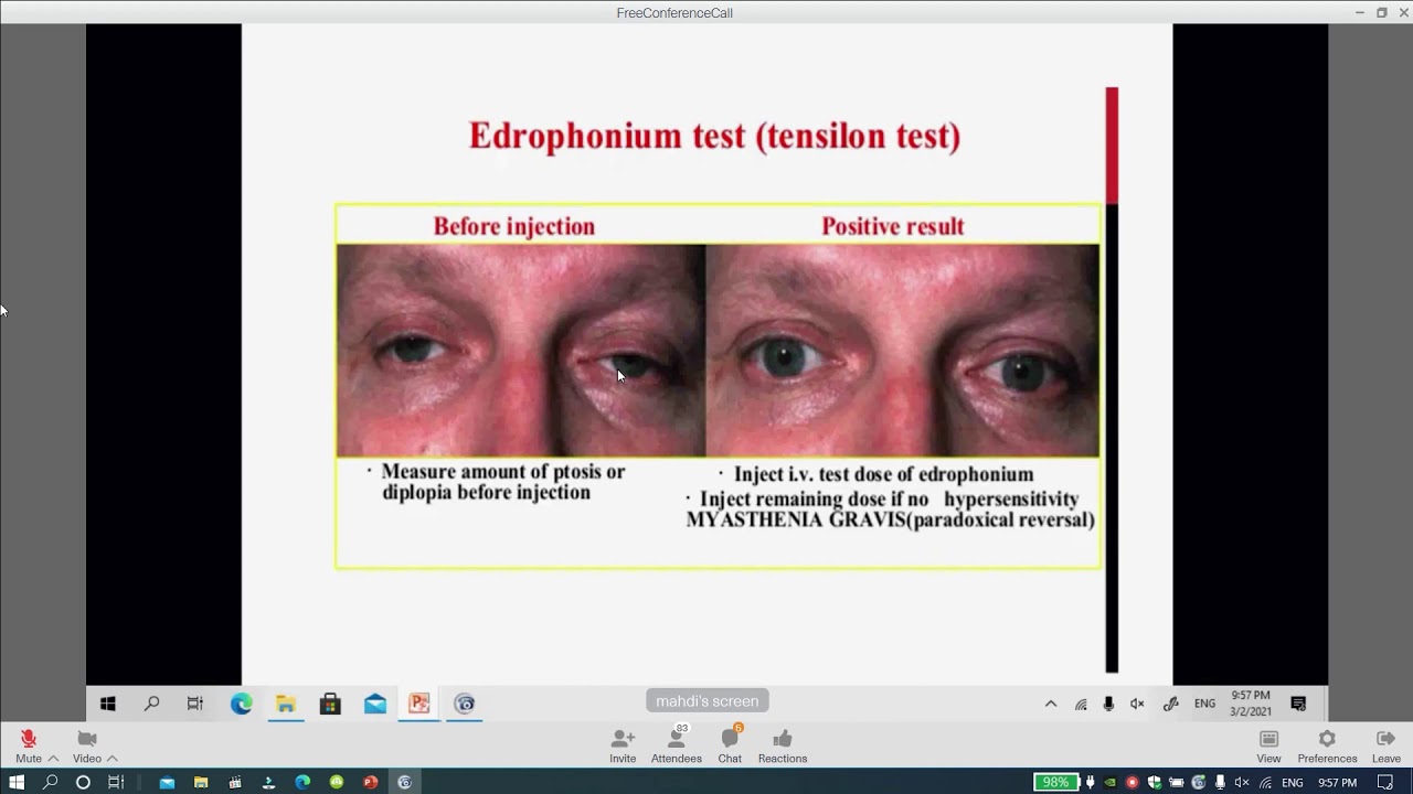 Myasthenia Gravis, Lambert Eaton Syndrome, Myasthenic Syndrome - YouTube
