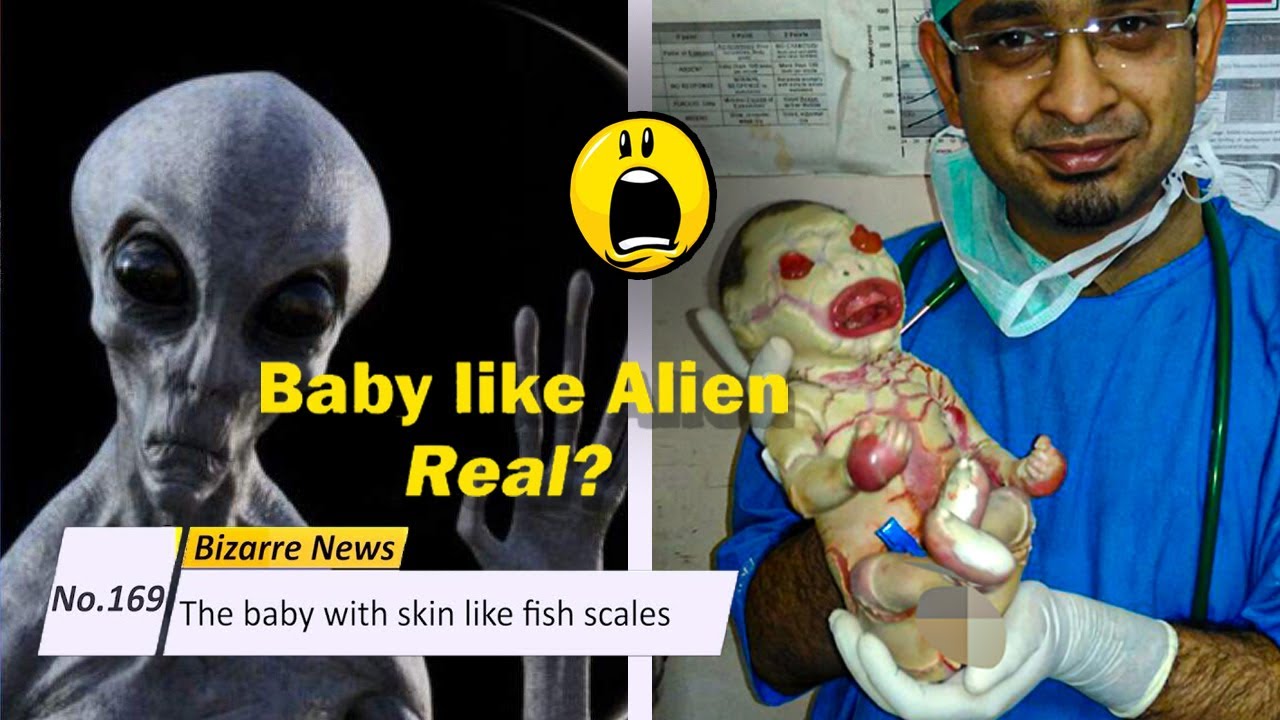 No. 169, Bizarre News : The baby with skin like fish scales. (ISL ...