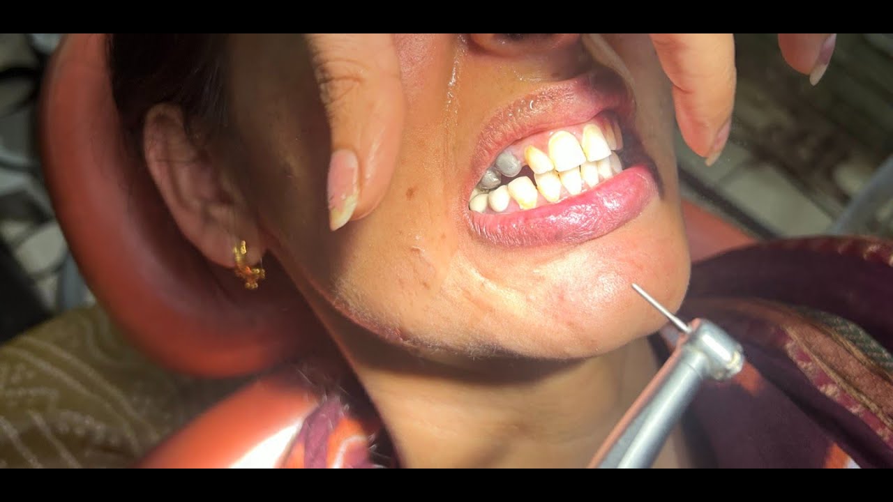 Post and Core Restoration (Quick Tutorial) #PuneDentalClinic - YouTube