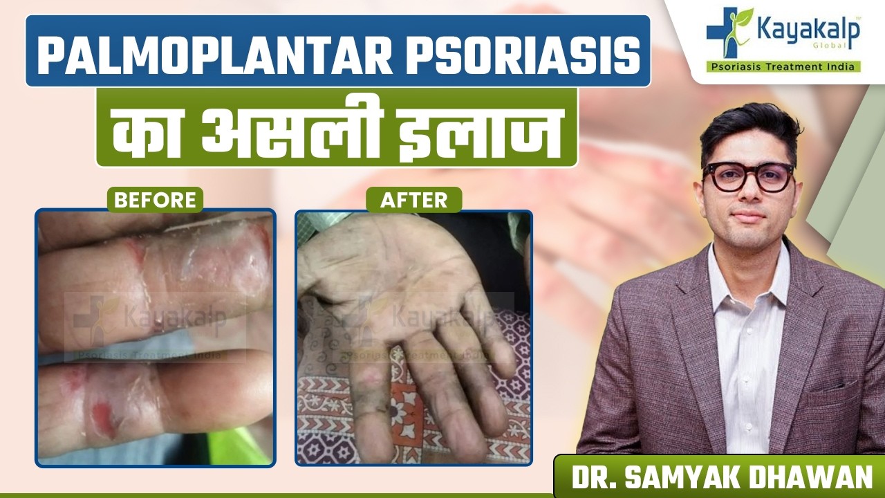 Palmoplantar Psoriasis का असली इलाज | Psoriasis Treatment in Hindi ...