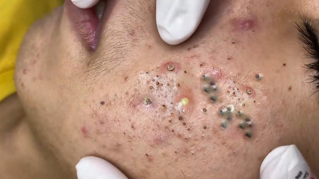 Big Cystic Acne Blackheads Extraction Blackheads & Milia, Whiteheads ...