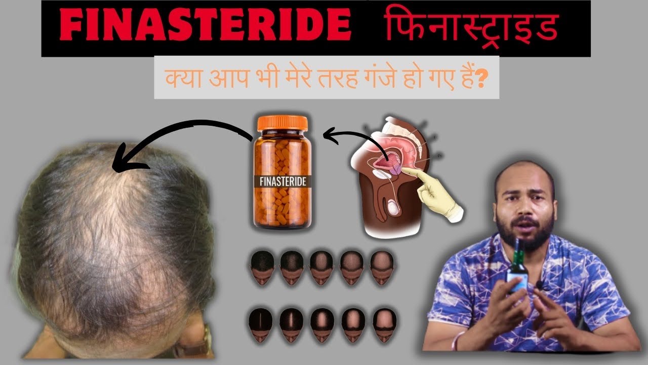 Finasteride | 100% Solution for Thinning Hair | बालों के गिरने का अंत | फिनास्ट्राइड का सच - YouTube