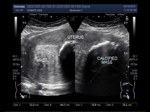 Ultrasound Video showing a Large Calcified Fibroids. - YouTube