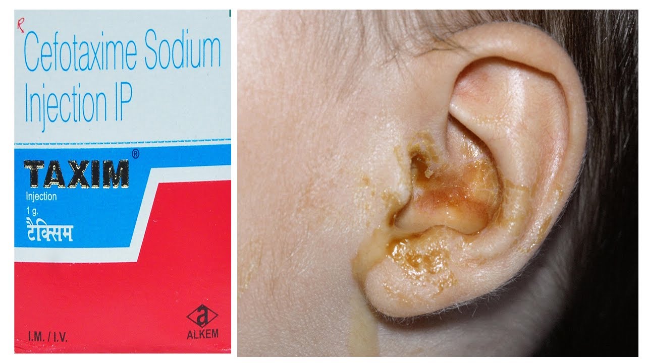 Taxim 1gm Injection = शरीर में बैक्टीरिया की इन्फेक्शन को ख़तम करे सेल ...