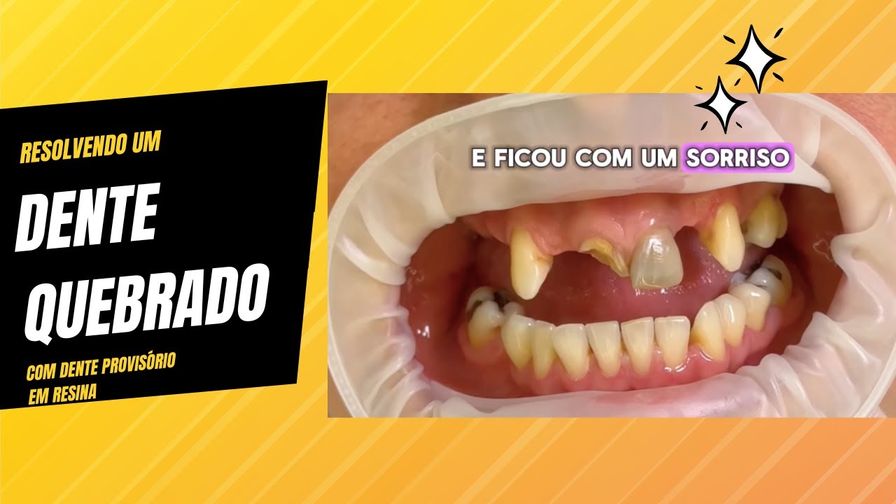 Paciente com DENTE QUEBRADO: Fazendo um DENTE PROVISÓRIO em Resina ...