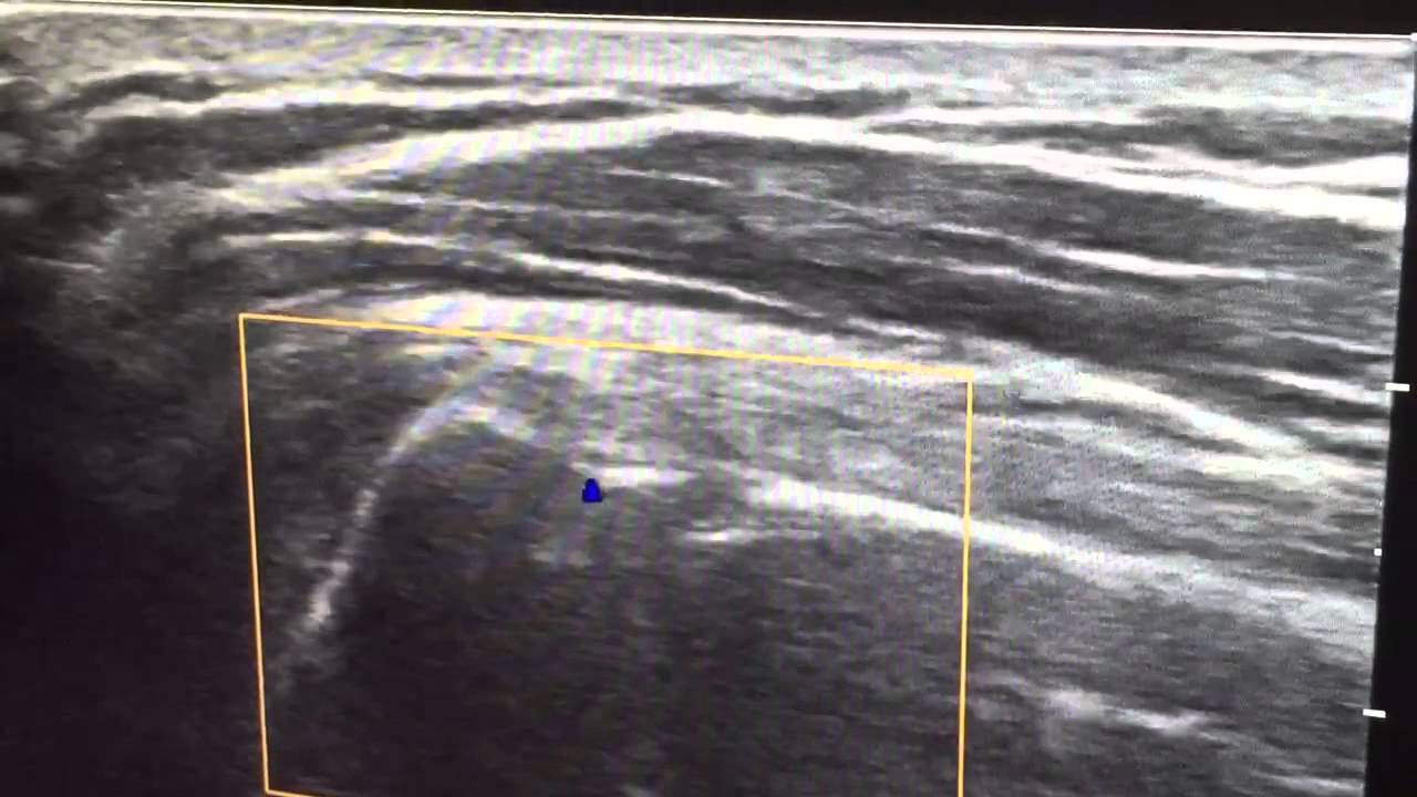 Nutrient foramen bicipital groove - YouTube