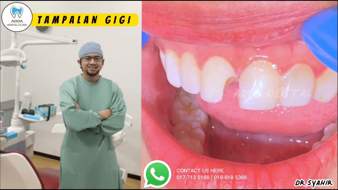 Gigi Depan Patah | Tampalan Gigi | Fillings | Dentist | Adda Dental Clinic - YouTube
