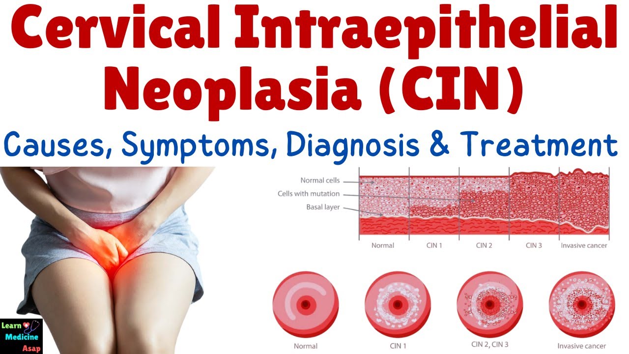 Cervical Intraepithelial Neoplasia (CIN) – Causes, Symptoms, Diagnosis ...