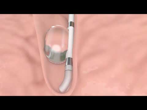 The Tempo® Temporary Pacing Lead from BioTrace Medical Inc. - YouTube