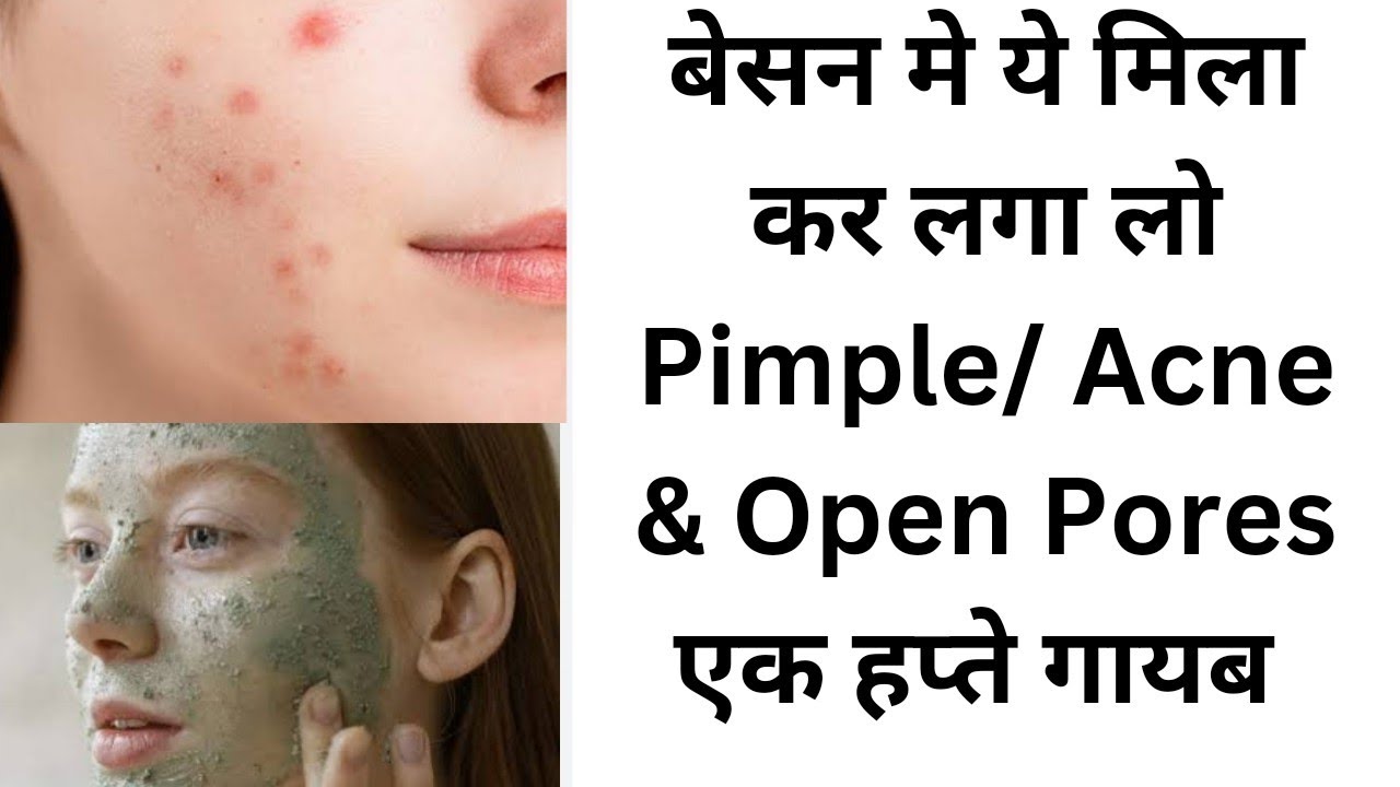 Pimple / acne & Open Pores ke liye best Homeremedy😍 #skincare - YouTube