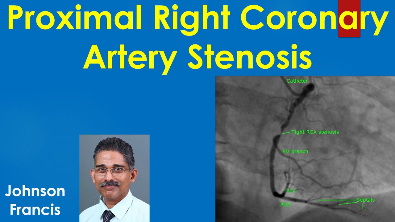 Proximal Right Coronary Artery Stenosis - YouTube