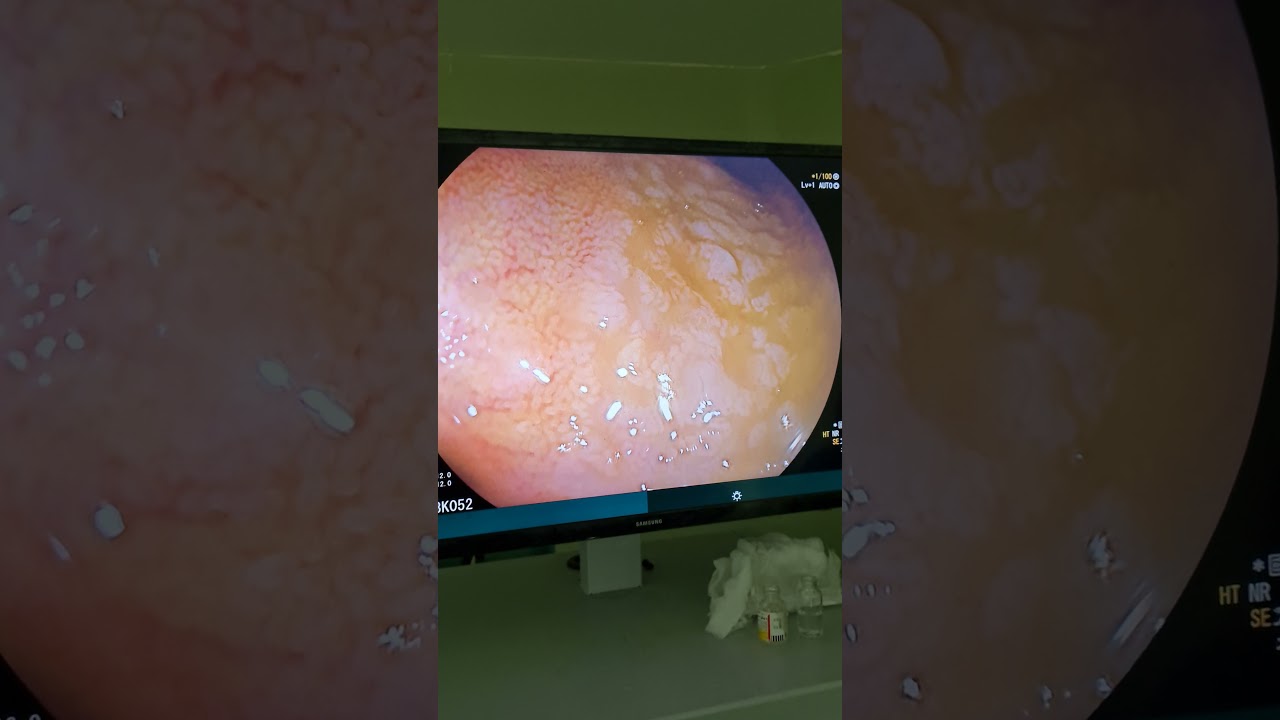 دوده في الأمعاء الرفيعه helminthes in terminal ileoscopy, colonoscopy - YouTube