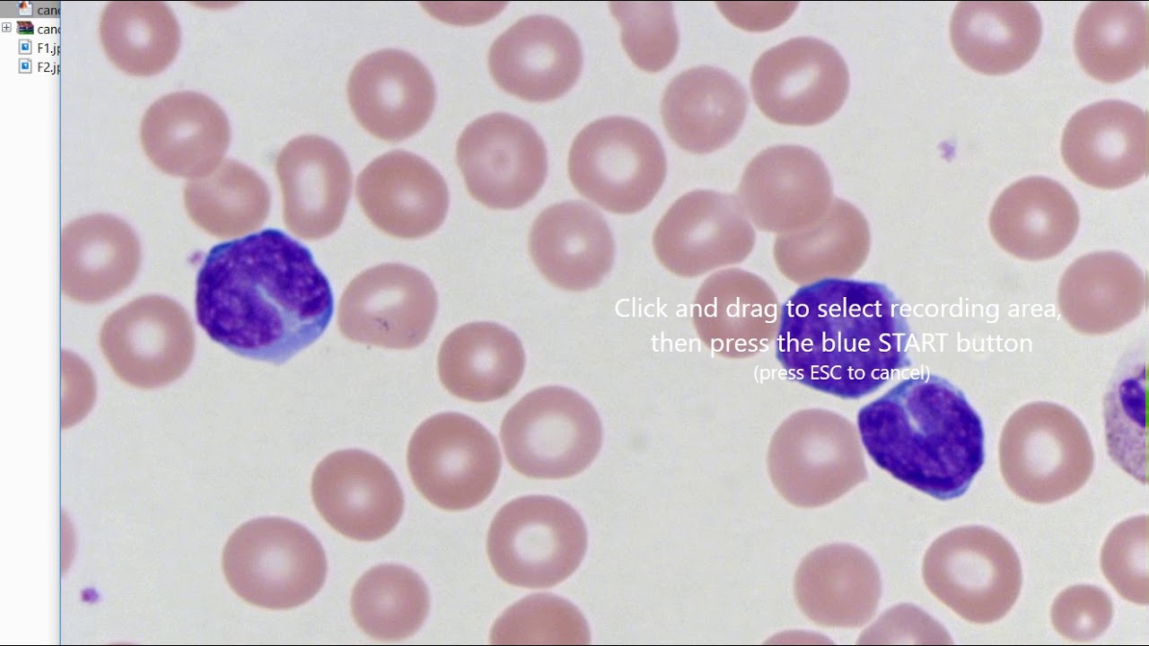 leukemia cancer detection - YouTube