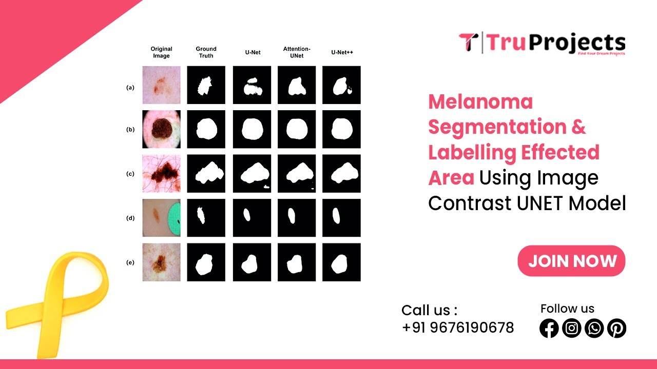 Melanoma Segmentation & Labelling Effected Area Using Image Contrast UNET Model mca projects ...