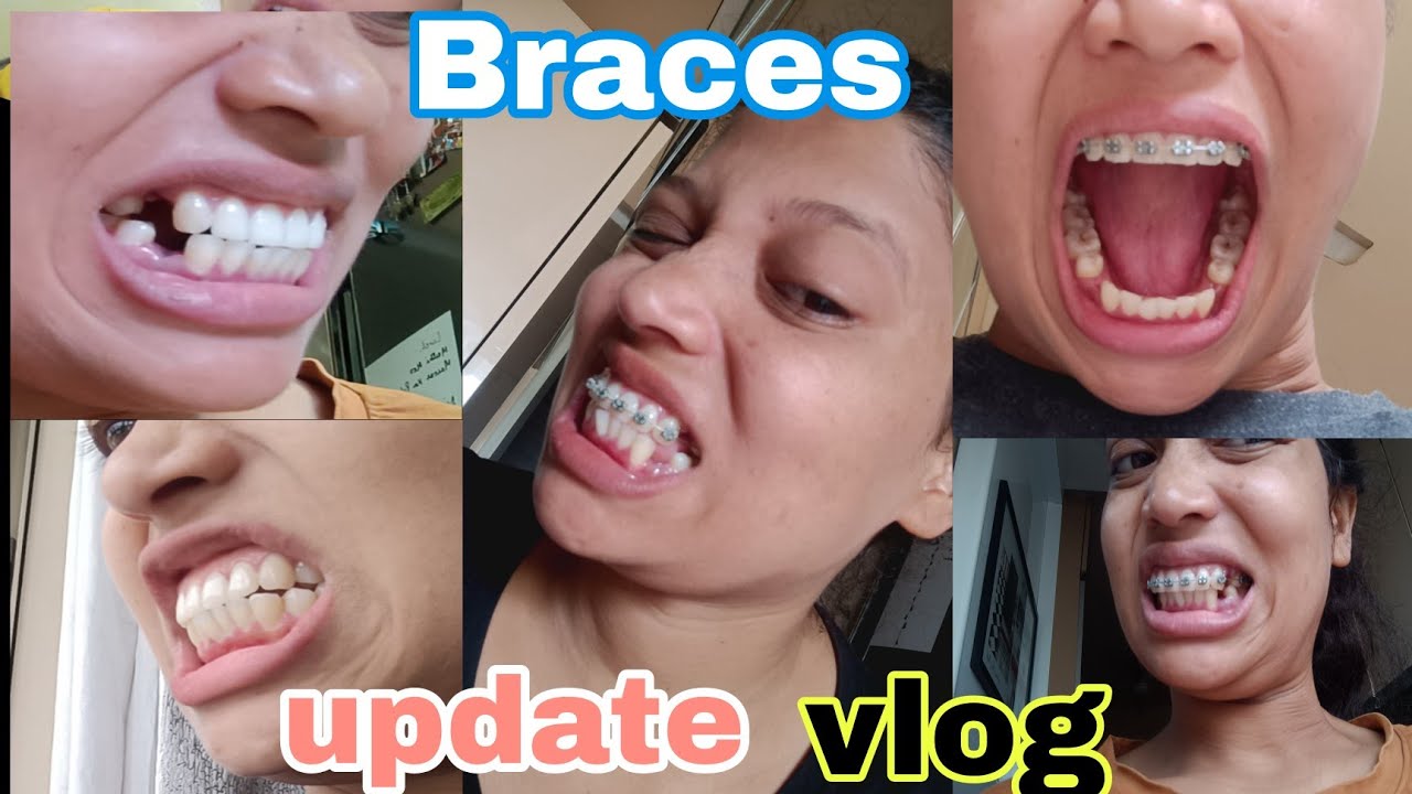 Braces update 👆 - YouTube