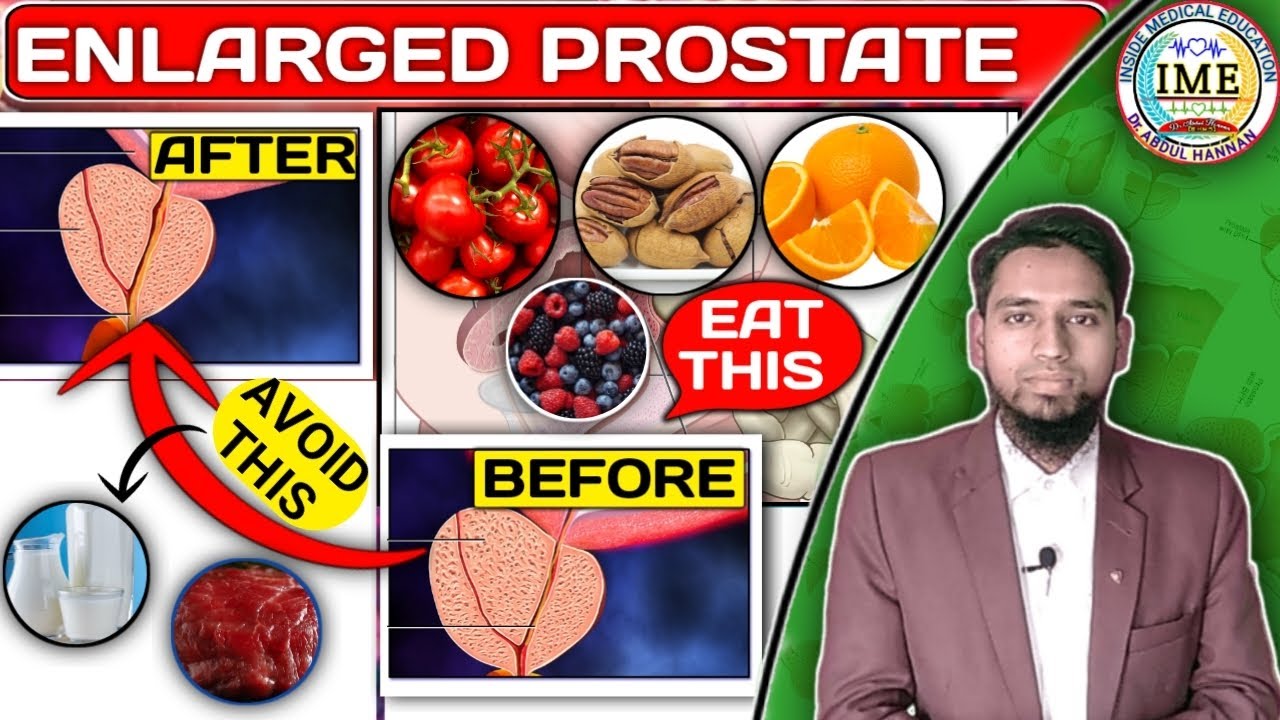 Enlarged prostate food|| Which foods avoid in enlarged prostate|| BPH ...