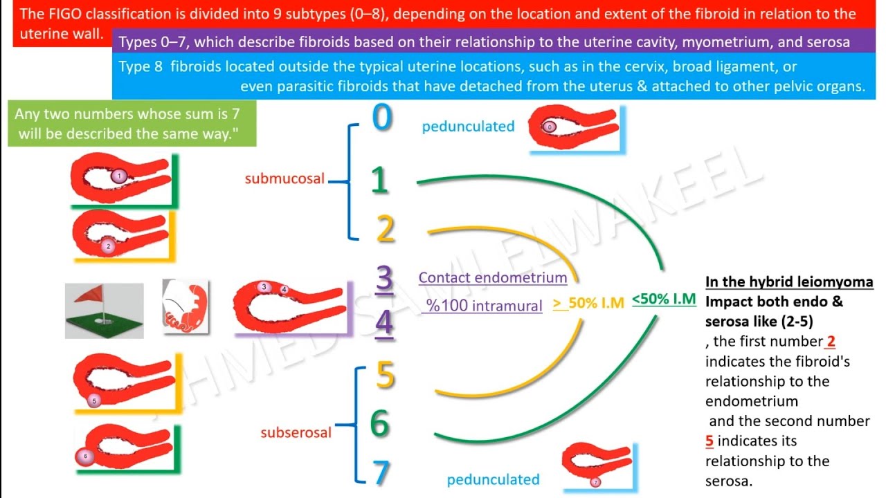 figo classification of fibroids made easy and fibroids degeneration ...