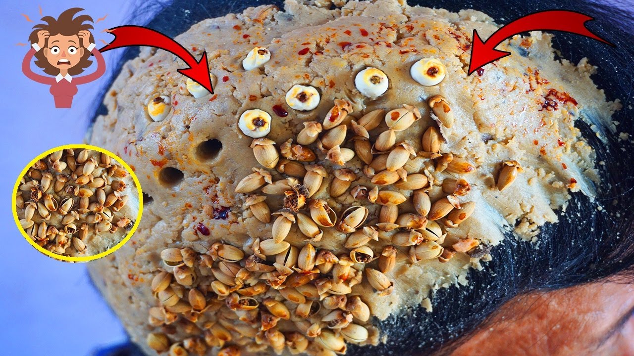 OMG Wild Ticks!! Removing Million Ticks On Headache Poor #1065 - YouTube