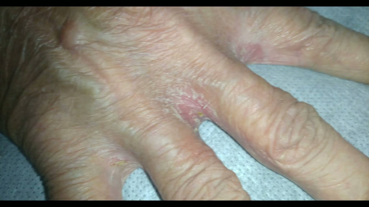 Intertrigo (intertriginous dermatitis) #imwell #yoga #skin # ...