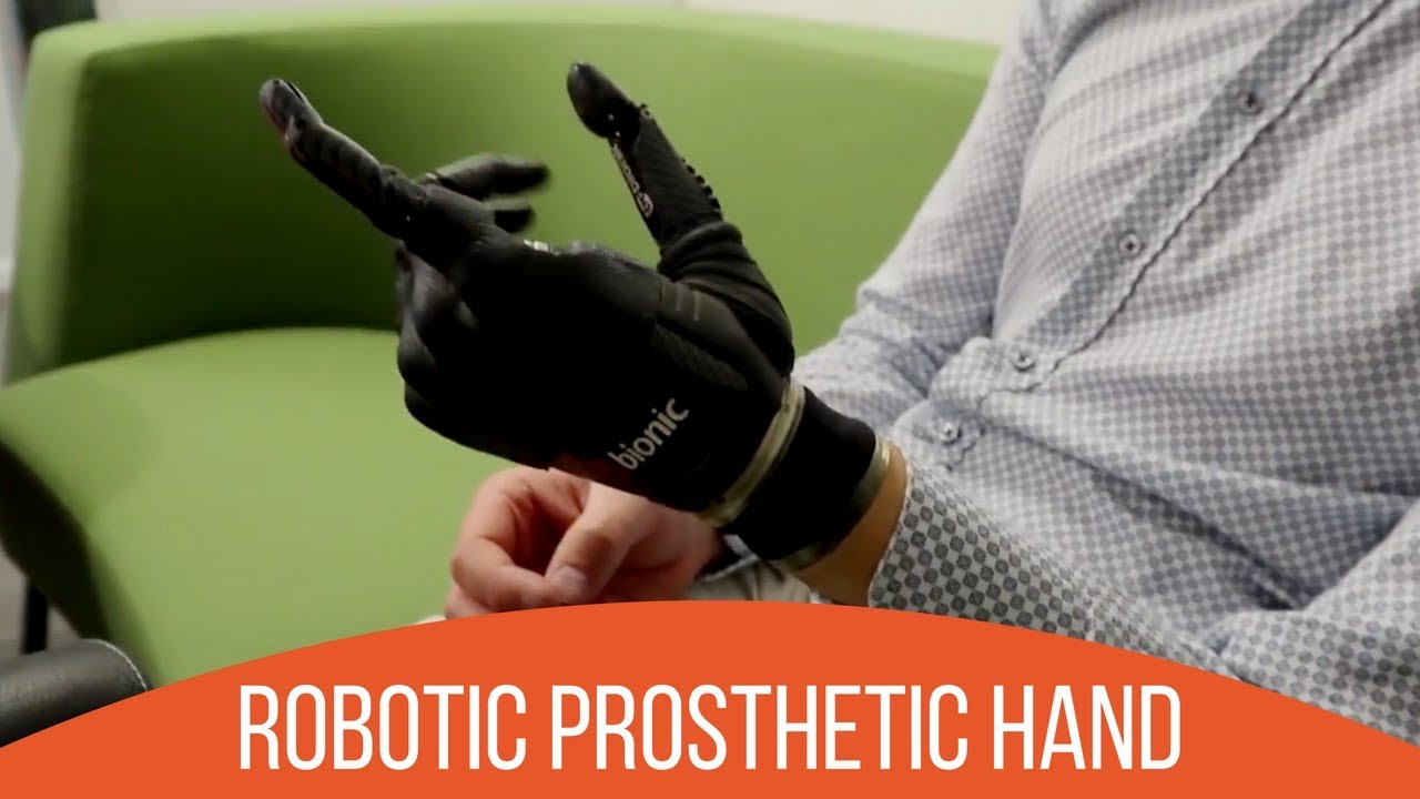 Review of The Bebionic Hand by Triple Amputee - YouTube