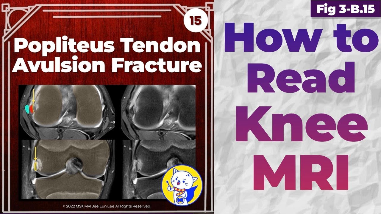 (Fig 3-B.15) Popliteus Tendon Avulsion Fracture - YouTube