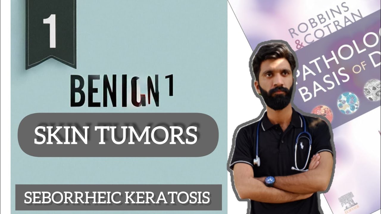 "Seborrheic Keratosis: Complete Guide to Benign Skin Tumors and ...