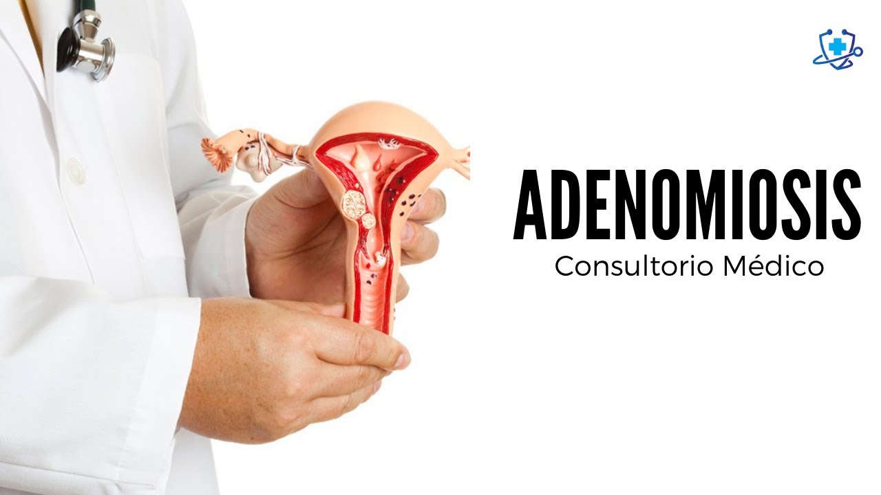 La Adenomiosis Definición, Síntomas, Causas y Factores de riesgo ...