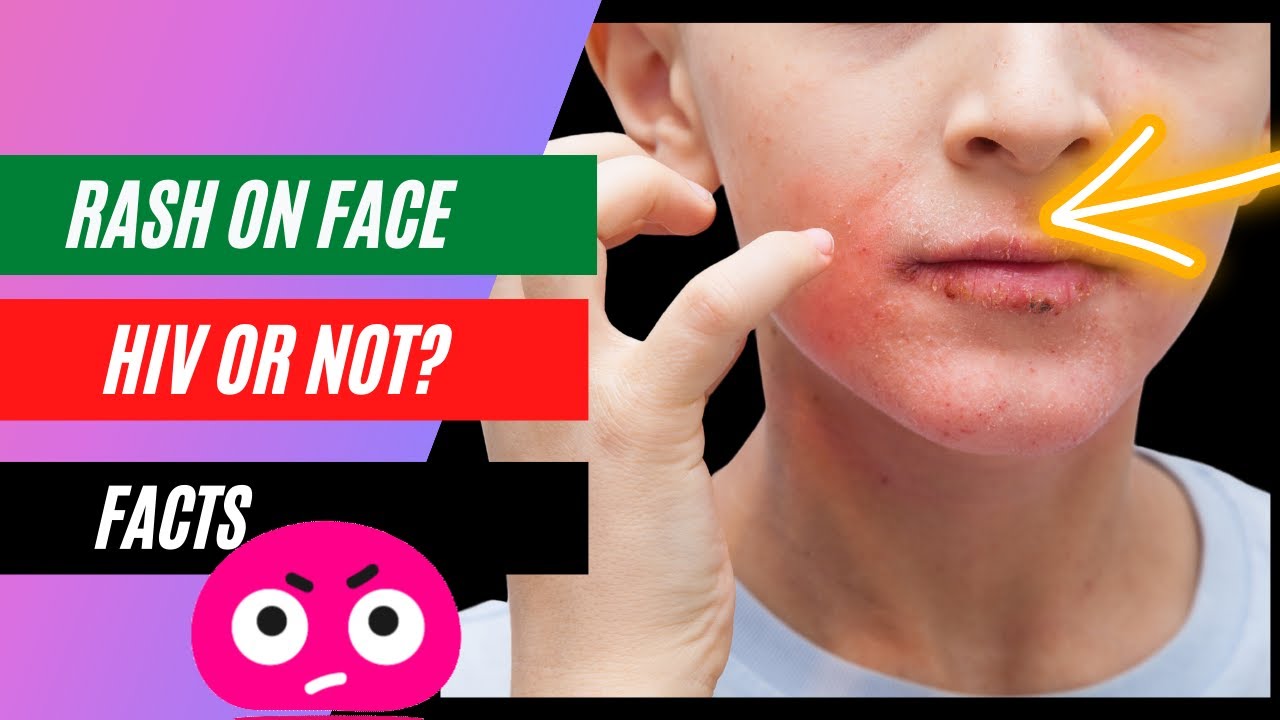 Reasons why a rash on face could be a sign and symptoms of HIV or AIDS ...