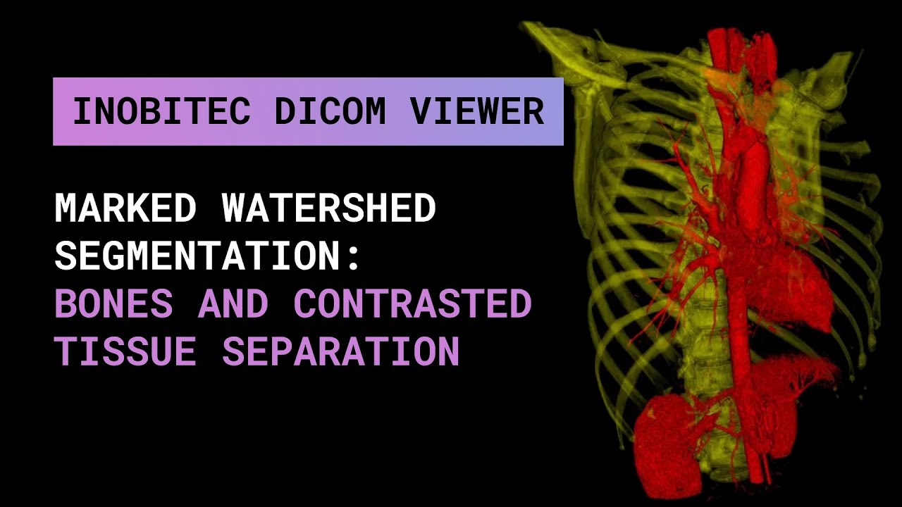 Marked watershed segmentation: bones and contrasted tissue separation ...