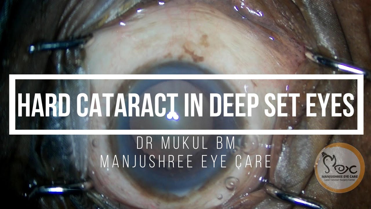 HARD CATARACT IN DEEP SET EYES - YouTube