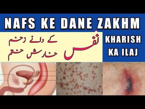 Nafs ke dane ka ilaj#nafs ke zakhm ka ilaj#nafs ki kharish ka ilaj#nafs ...