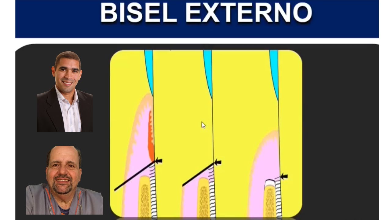 BISEL EXTERNO @dr.alexguedes - YouTube