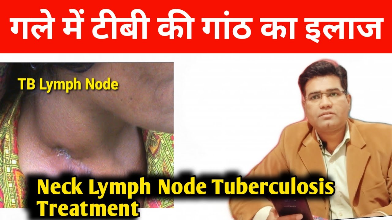 What Are Cervical Tuberculosis Cause Symptoms And Treatment टीबी की